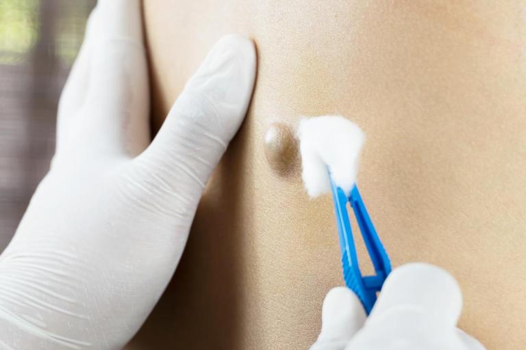 Qual è la differenza tra una ciste e un tumore? – Farmajet